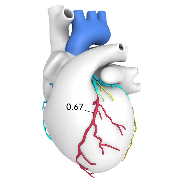 Heart Flow Analysis for Coronary Artery Disease | Georgia Heart Institute