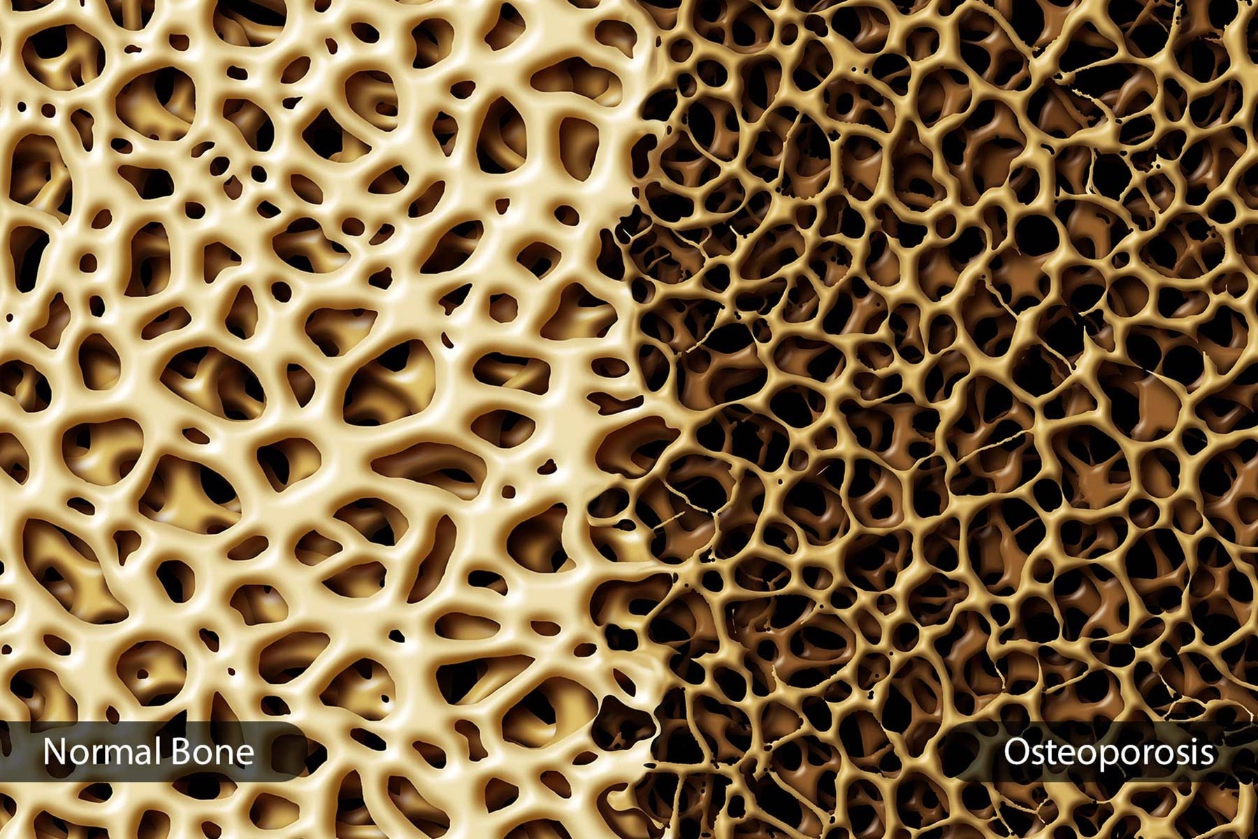 What is Osteoporosis? - Northeast Georgia Health System