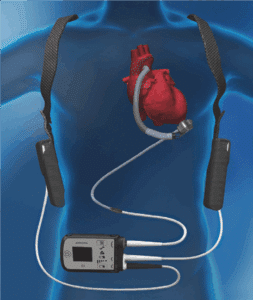 Left Ventricular Assist Device | LVAD | Georgia Heart Institute